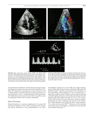 Echo assessment of coronary artery disease | PDF