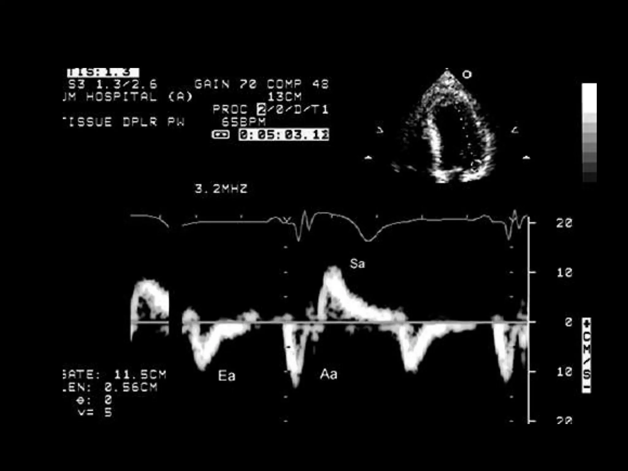 Echo assessment of lv systolic function and swma | PPTX