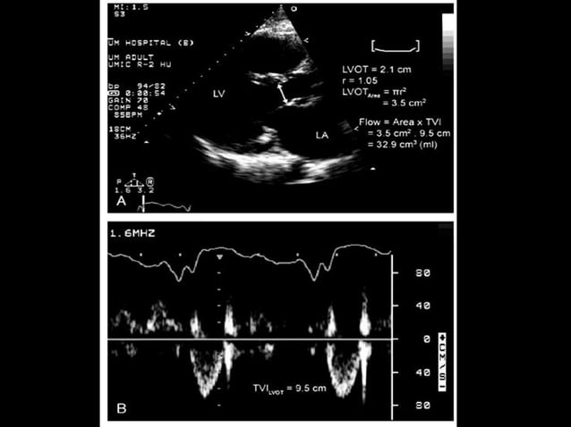 Echo assessment of lv systolic function and swma | PPTX | Heart and ...