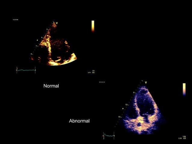 Echo assessment of lv systolic function and swma | PPTX | Heart and ...
