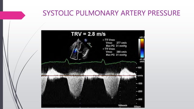 Echo assessment of RV function | PPTX | Heart and Cardiovascular ...