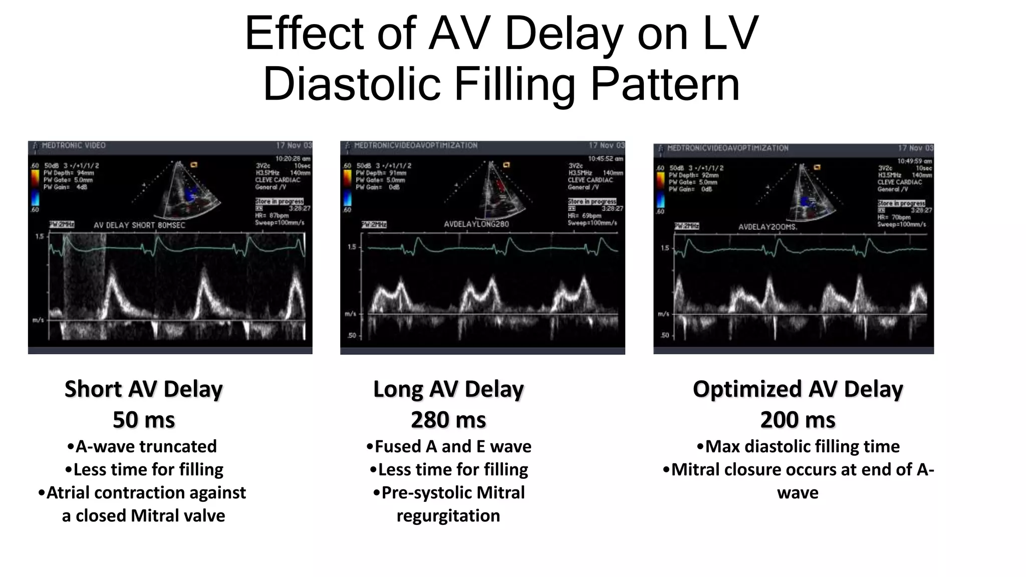 Echo base optimization of crt therapy | PPTX