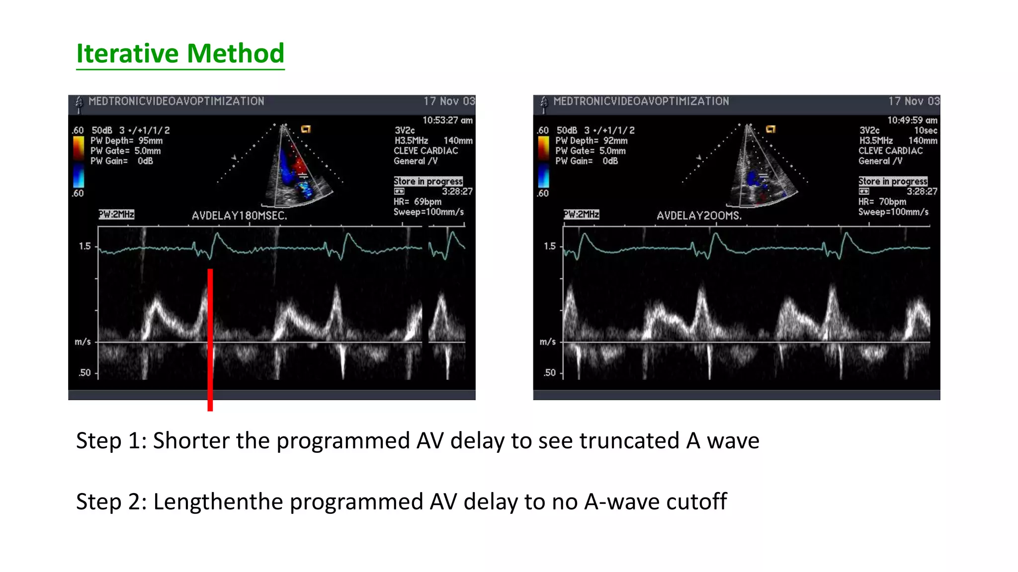 Echo base optimization of crt therapy | PPTX
