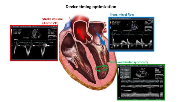 Echo base optimization of crt therapy