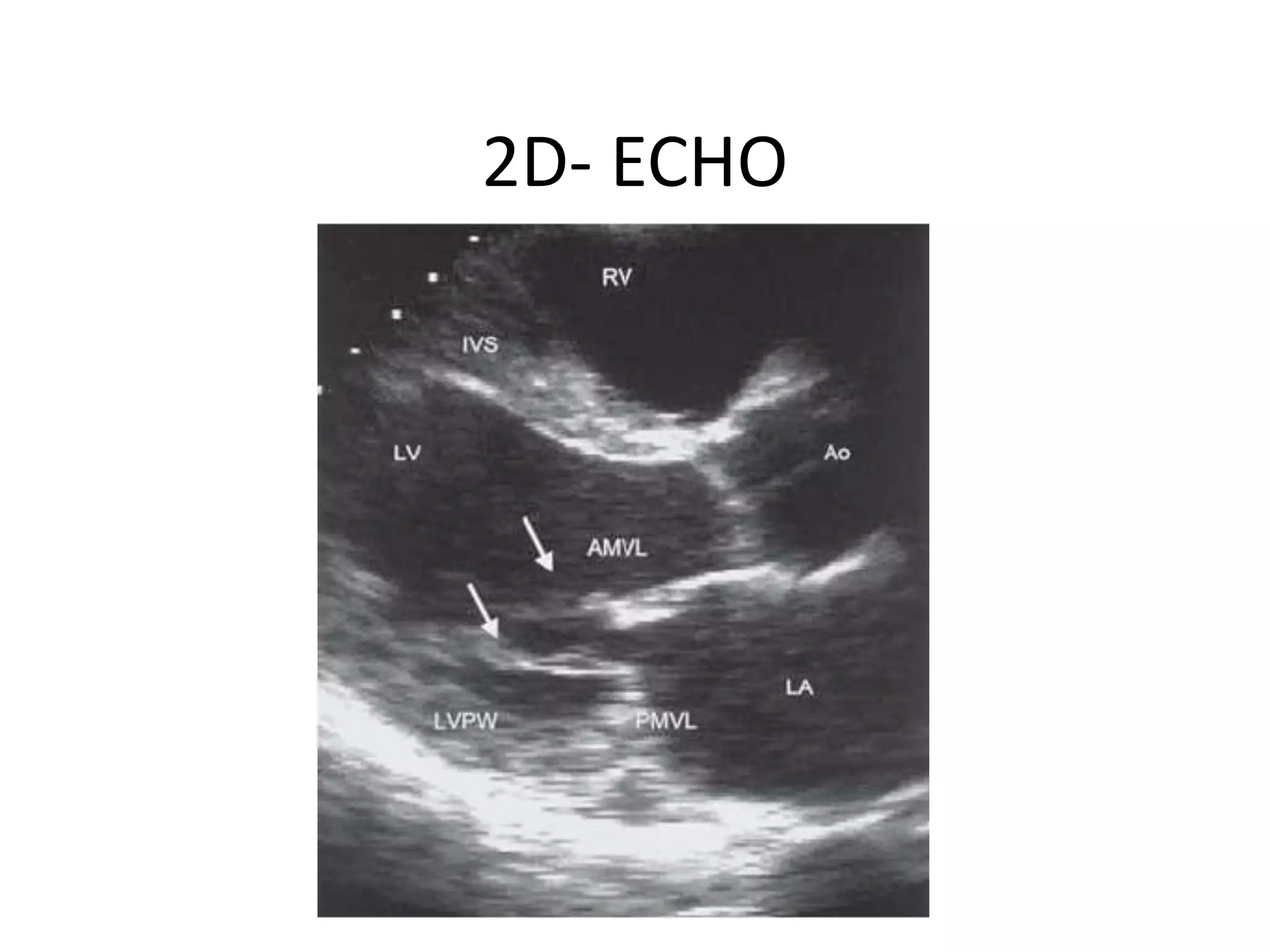 Basics of echocardiography | PDF