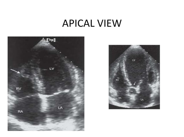 Basics of echocardiography | PPT