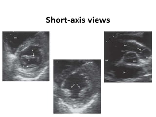 2D ECHO Basics | PPTX