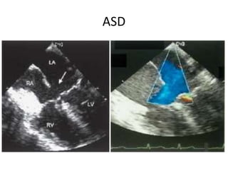 2D ECHO Basics | PPTX