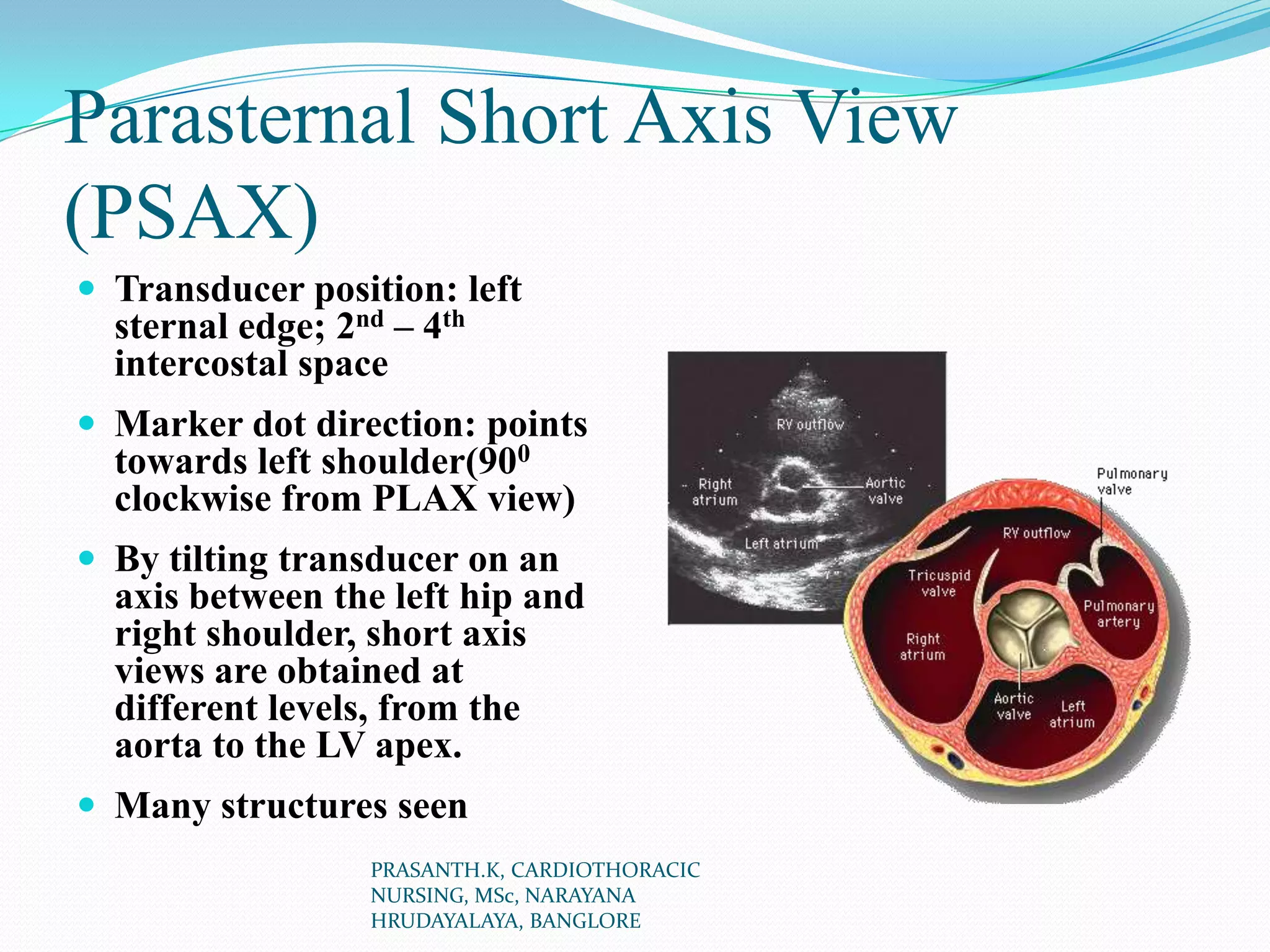 Echocardiogram Basics | PPSX