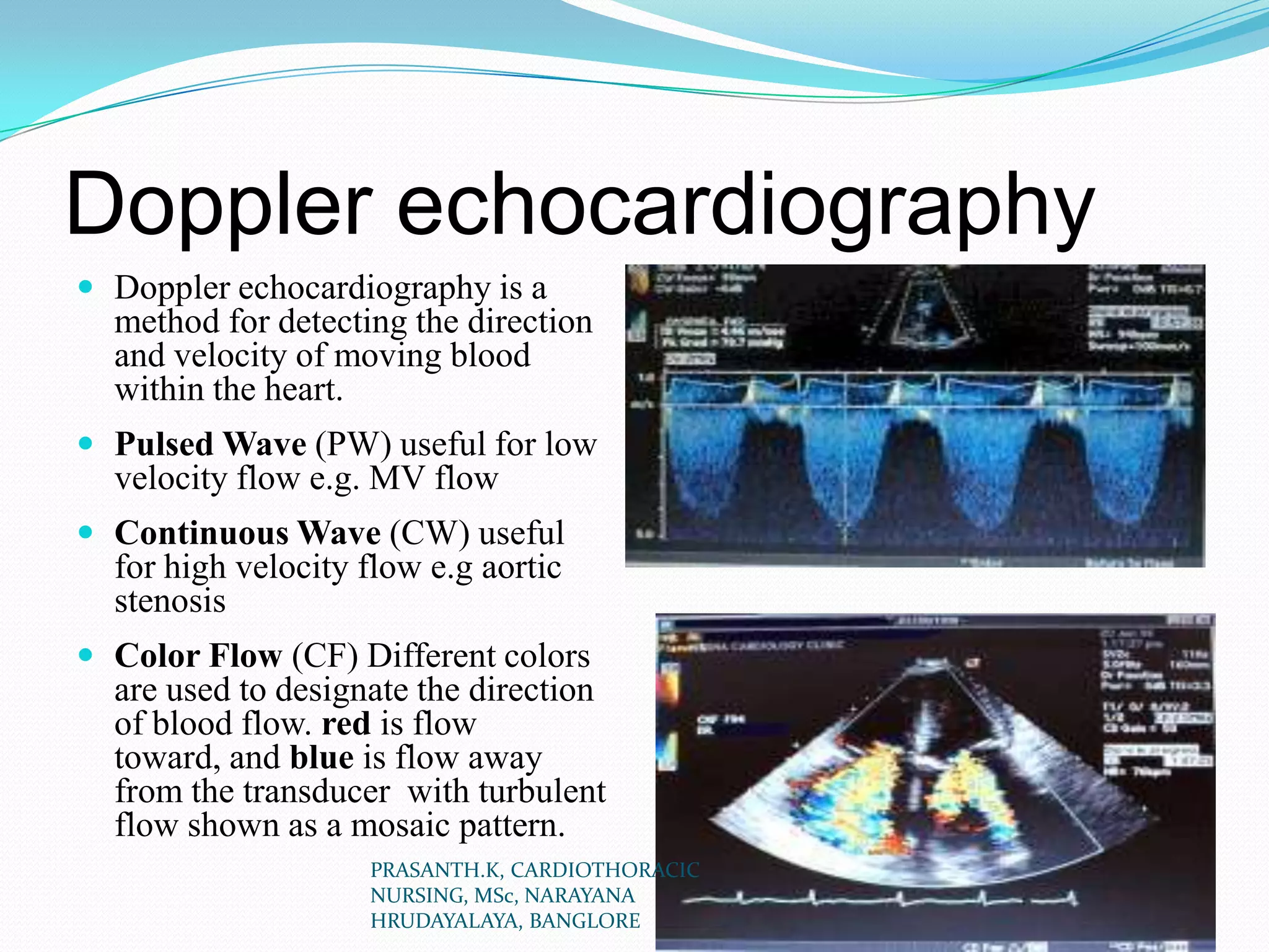 Echocardiogram Basics | PPSX