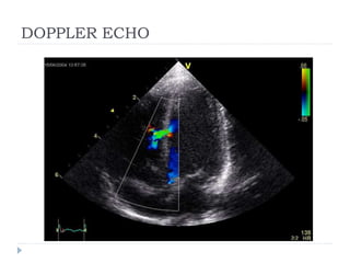 Echocardiogram | PPTX