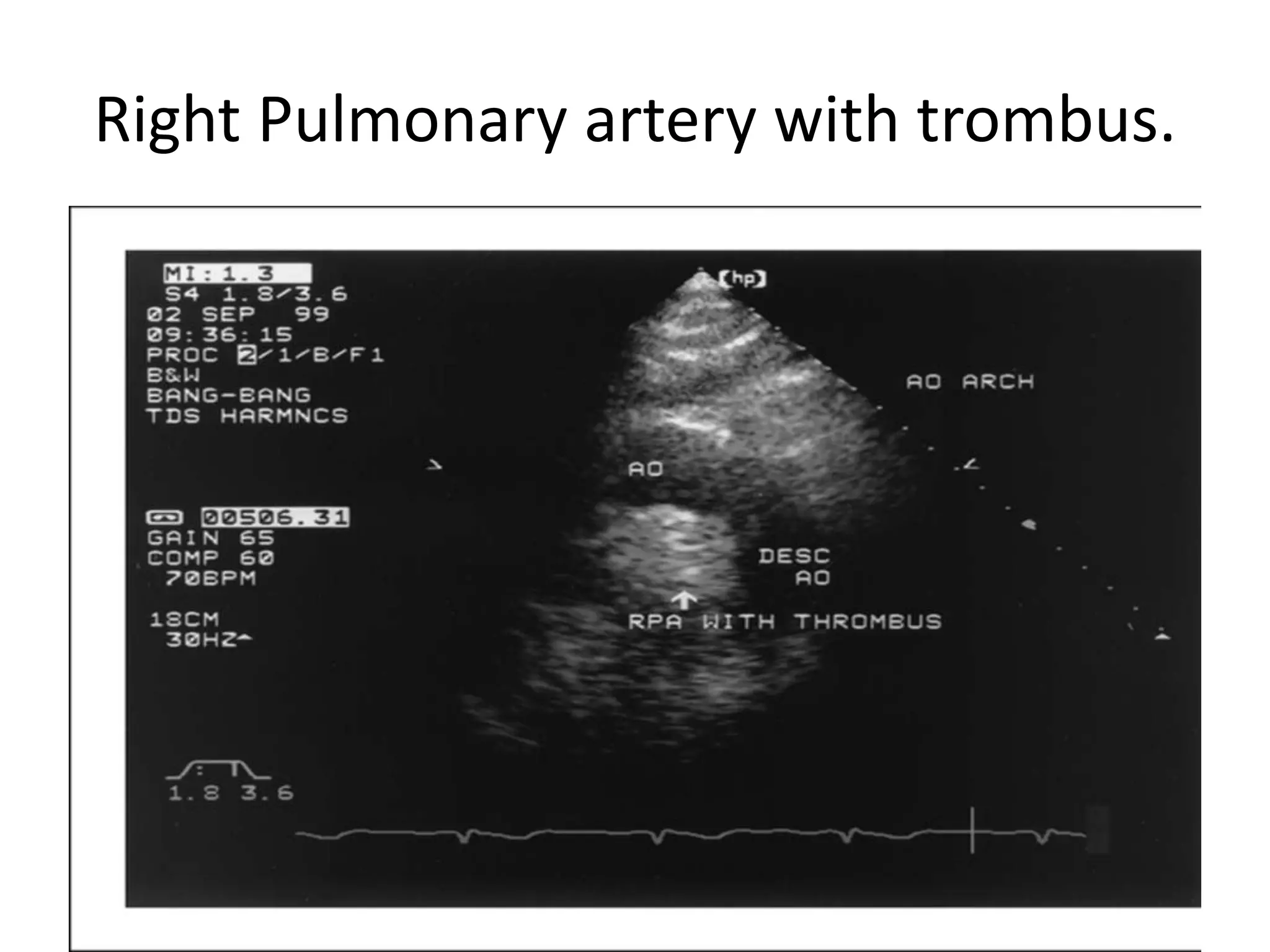 Echocardiogram acoustic windows | PPTX