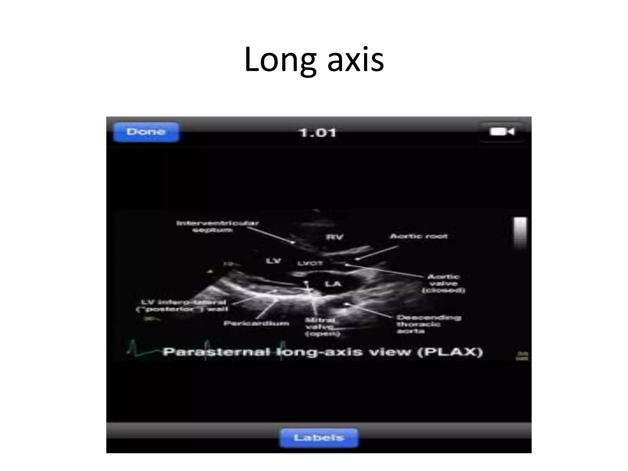 Echocardiogram acoustic windows | PPTX