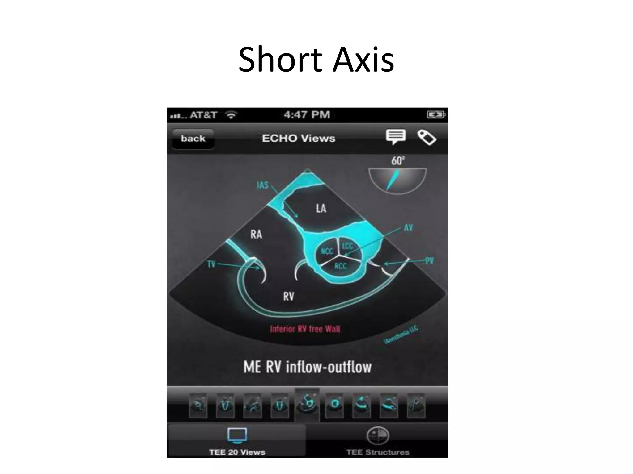 Echocardiogram acoustic windows | PPTX