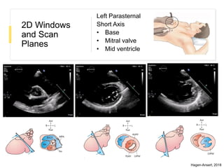 Echocardiogram Basics Iowa ACC CV Team 12-5-2020 1.pdf