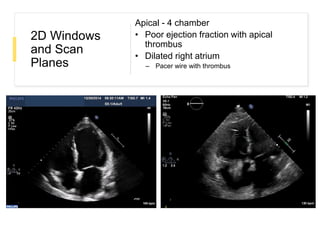Echocardiogram Basics Iowa ACC CV Team 12-5-2020 1.pdf