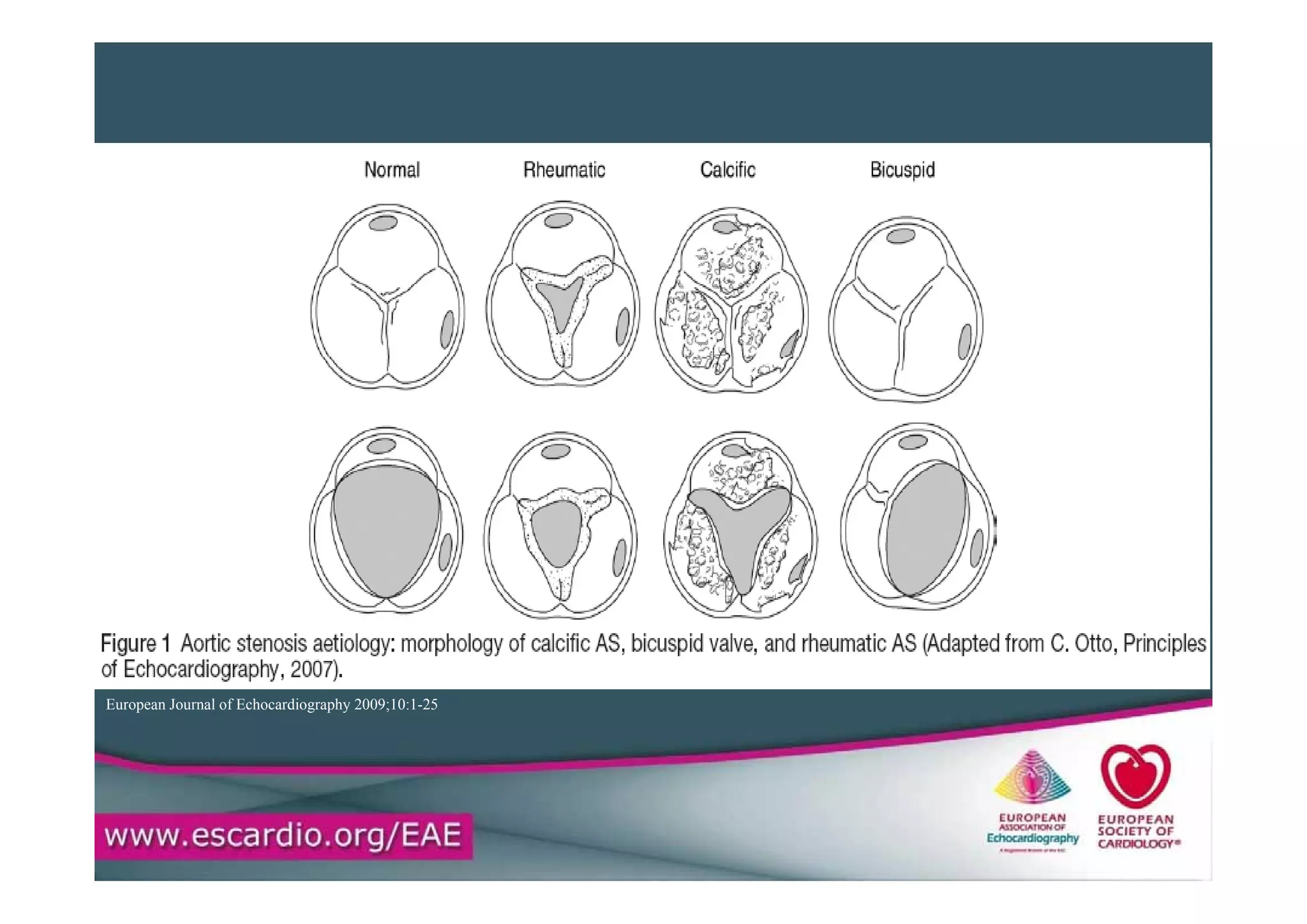 Aortic Stenosis Echo Ppt