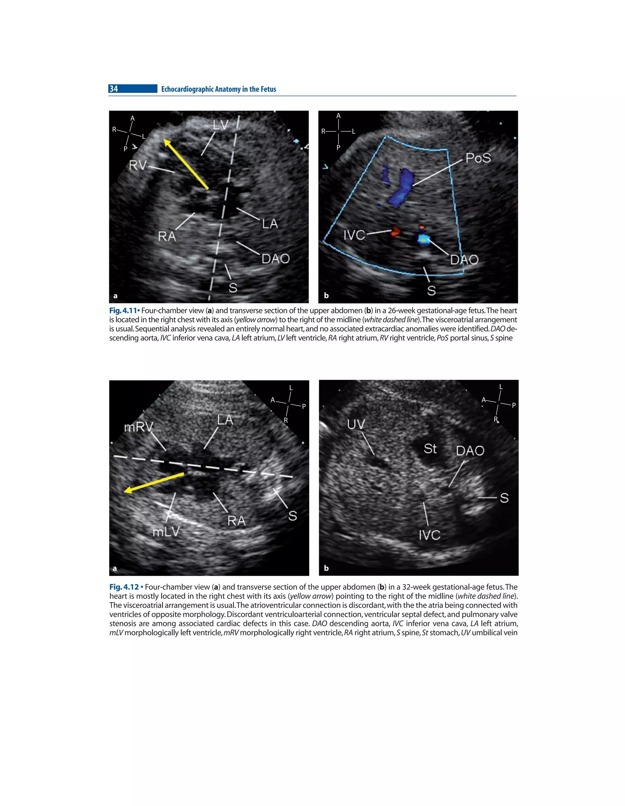Echocardiographic anatomy in the fetus 2009 pg | PDF