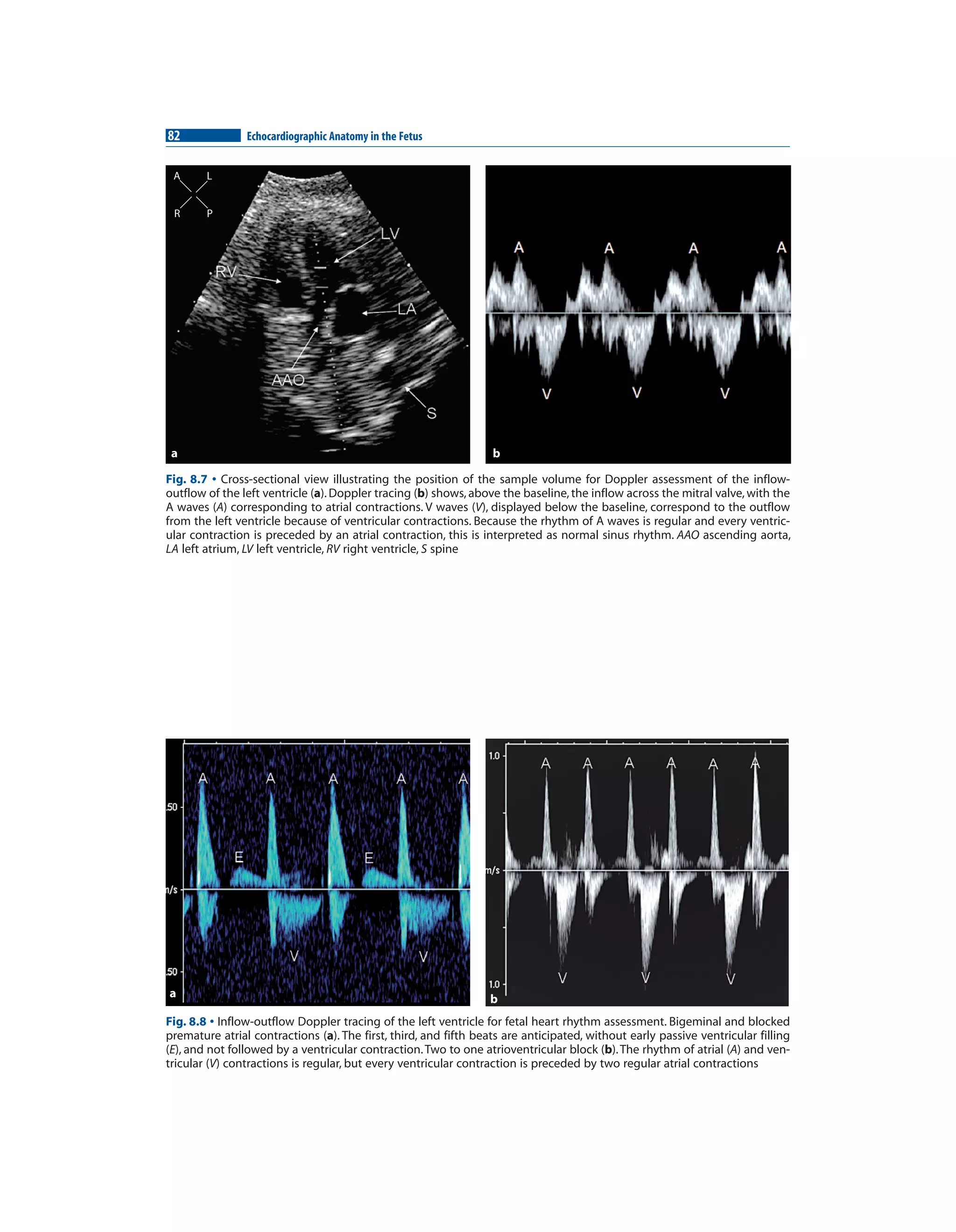 Echocardiographic anatomy in the fetus 2009 pg | PDF