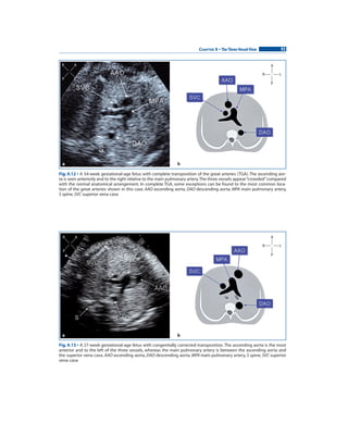 Echocardiographic anatomy in the fetus 2009 pg | PDF