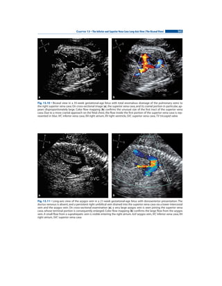 Echocardiographic anatomy in the fetus 2009 pg | PDF