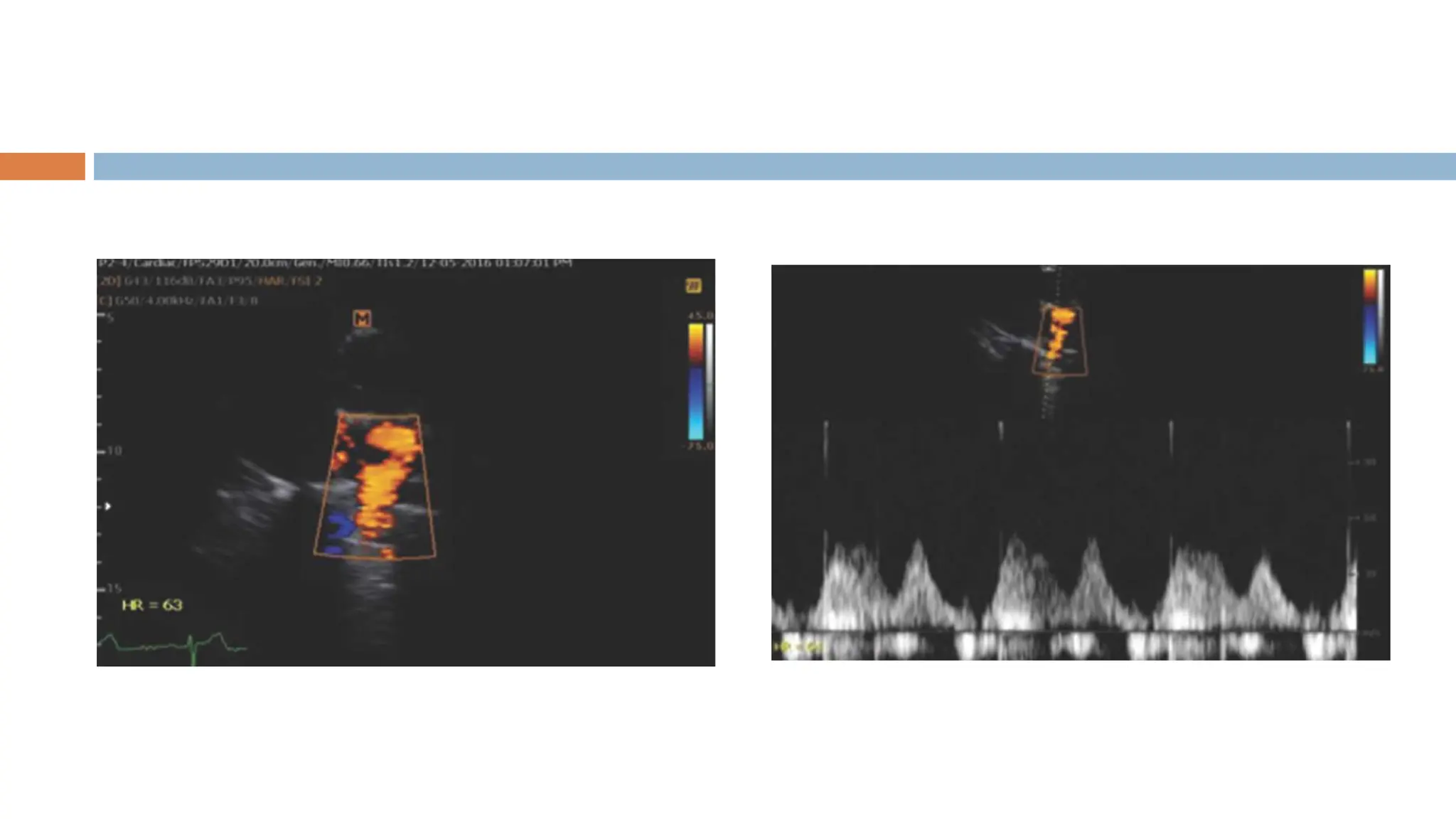ECHOCARDIOGRAPHIC ASSESMENT OF DIASTOLIC FUNCTION.pptx