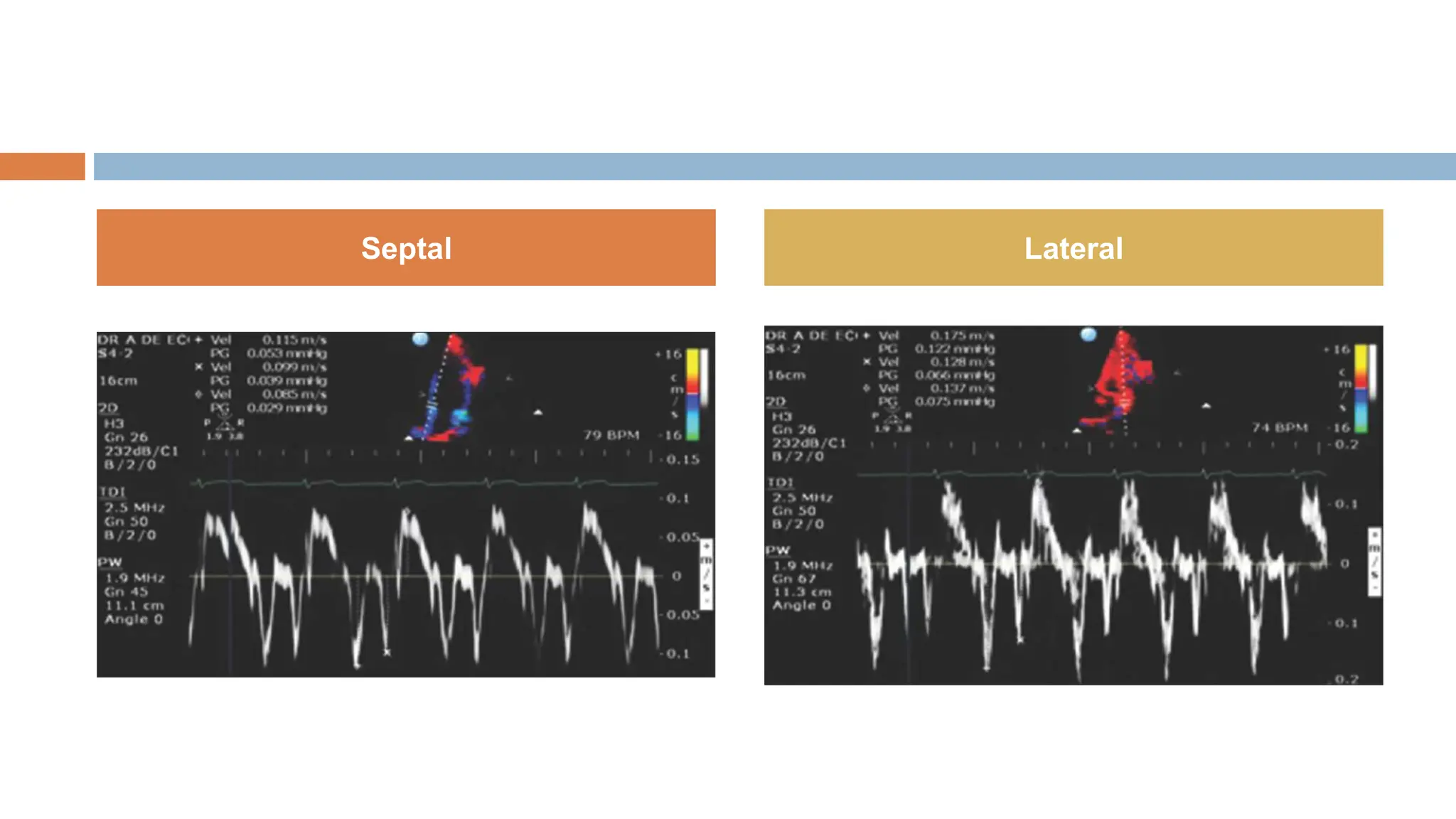 ECHOCARDIOGRAPHIC ASSESMENT OF DIASTOLIC FUNCTION.pptx