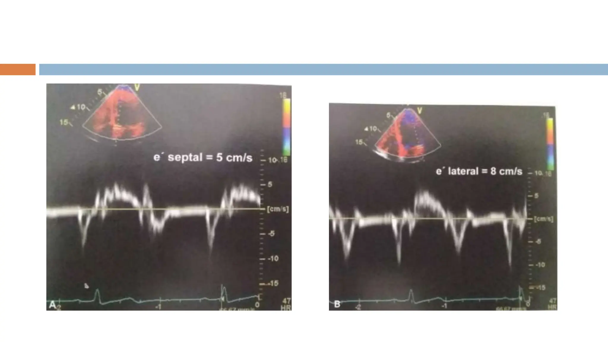 ECHOCARDIOGRAPHIC ASSESMENT OF DIASTOLIC FUNCTION.pptx