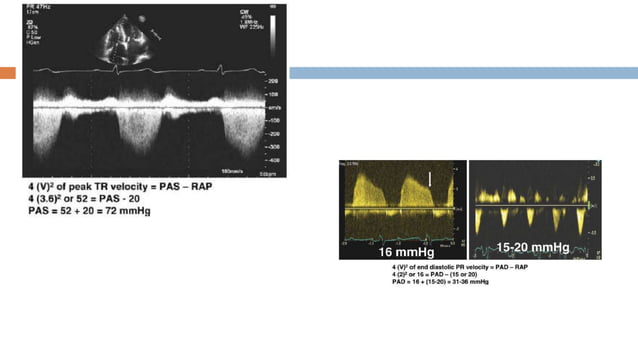 ECHOCARDIOGRAPHIC ASSESMENT OF DIASTOLIC FUNCTION.pptx