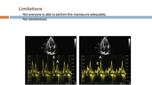 ECHOCARDIOGRAPHIC ASSESMENT OF DIASTOLIC FUNCTION.pptx