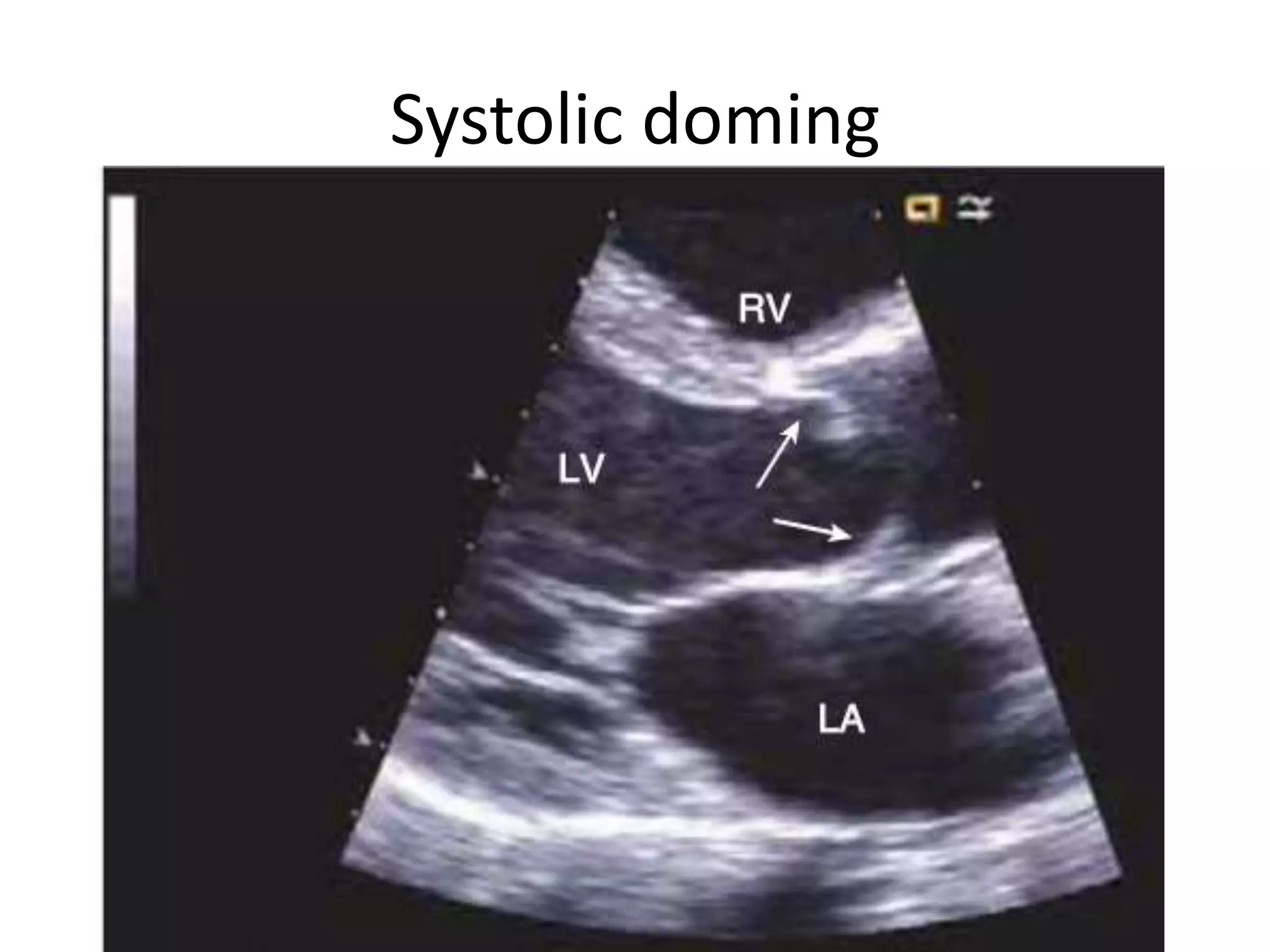 Echocardiographic assessment of aortic stenosis | PPTX