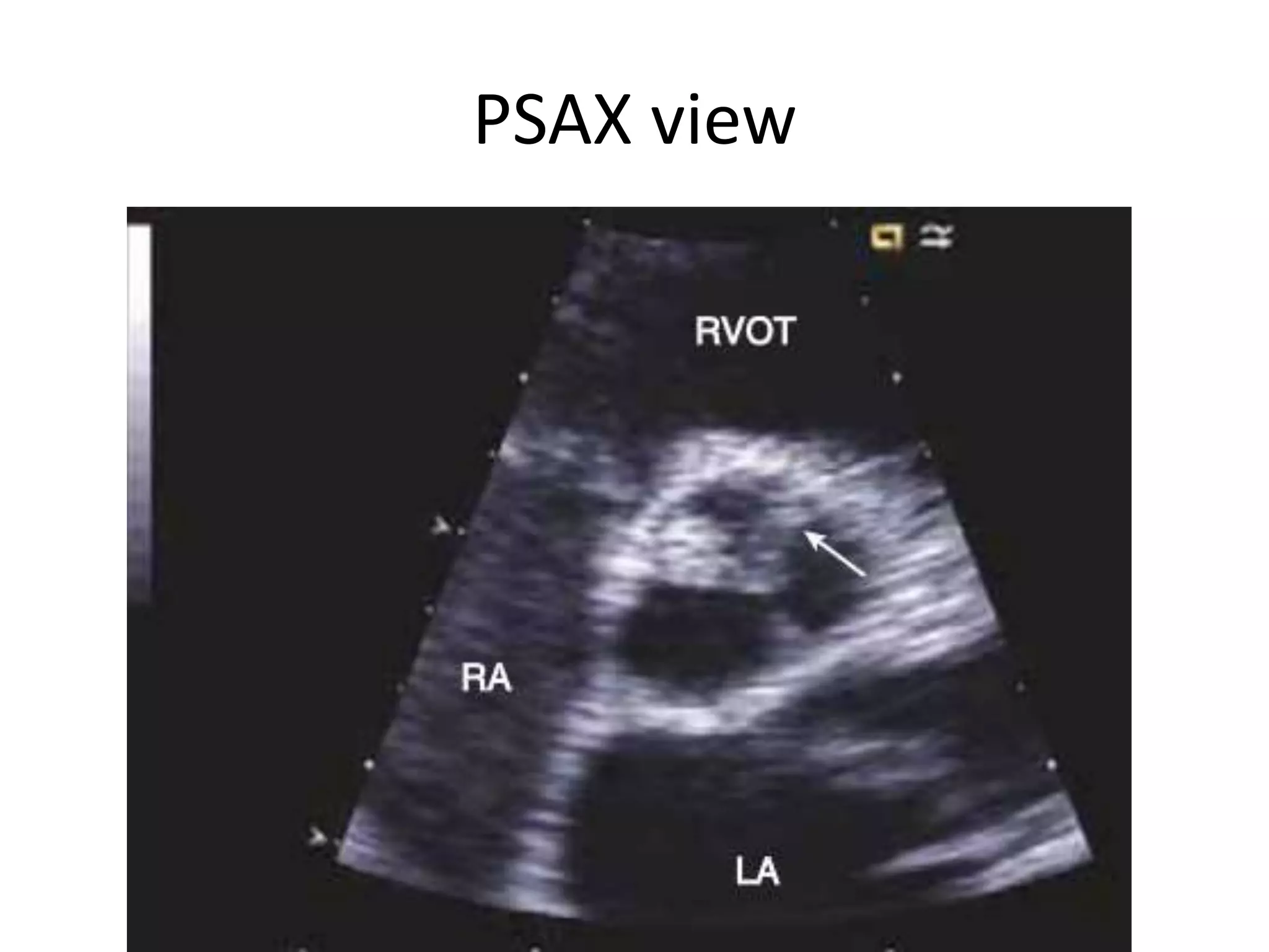 Echocardiographic assessment of aortic stenosis | PPTX