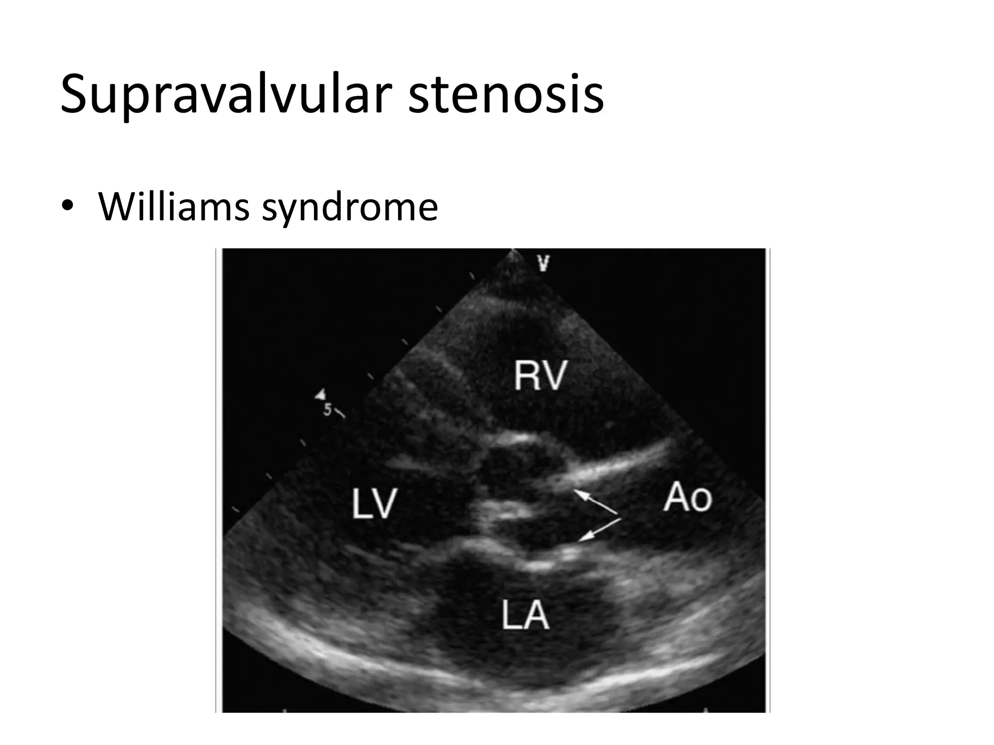 Echocardiographic assessment of aortic stenosis | PPTX