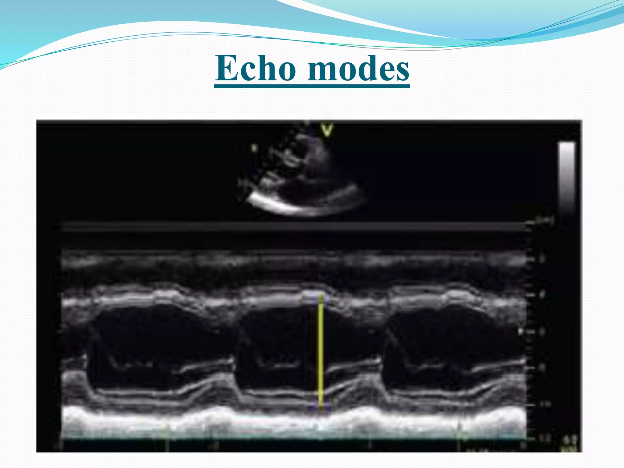Echocardiographic assessment of left ventricular systolic function | PPTX