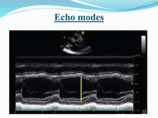 Echocardiographic assessment of left ventricular systolic function | PPTX