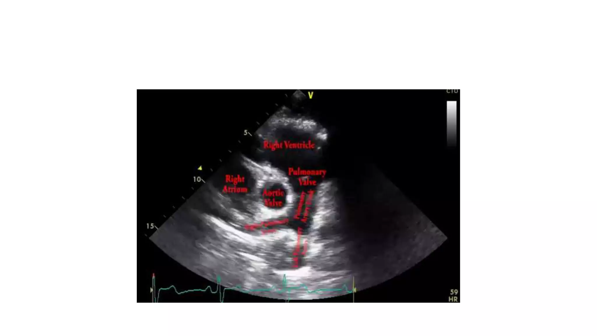 Echocardiographic Assessment of Pulmonary valve.pptx