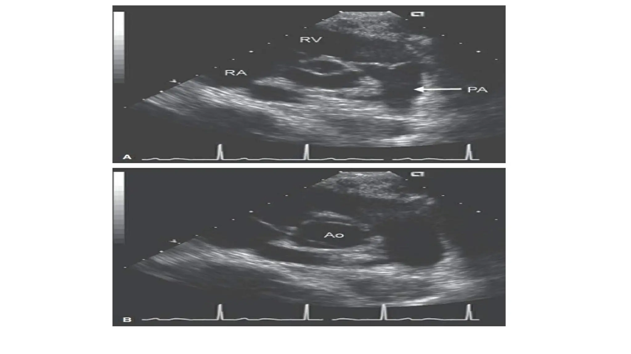 Echocardiographic assessment of tricuspid and pulmonary valves.pptx