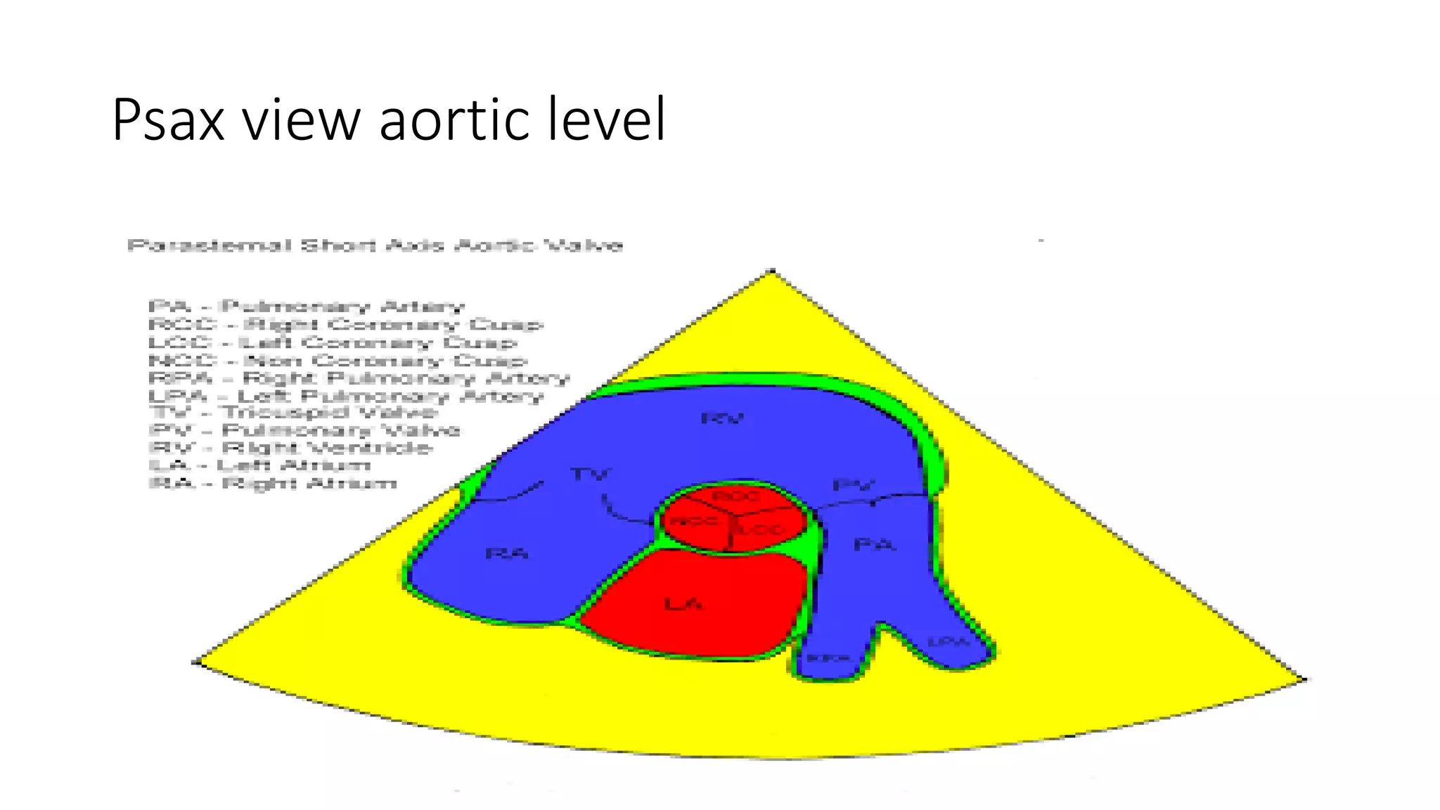 Echocardiographic evaluation of aortic valve and Aortic stenosis | PDF