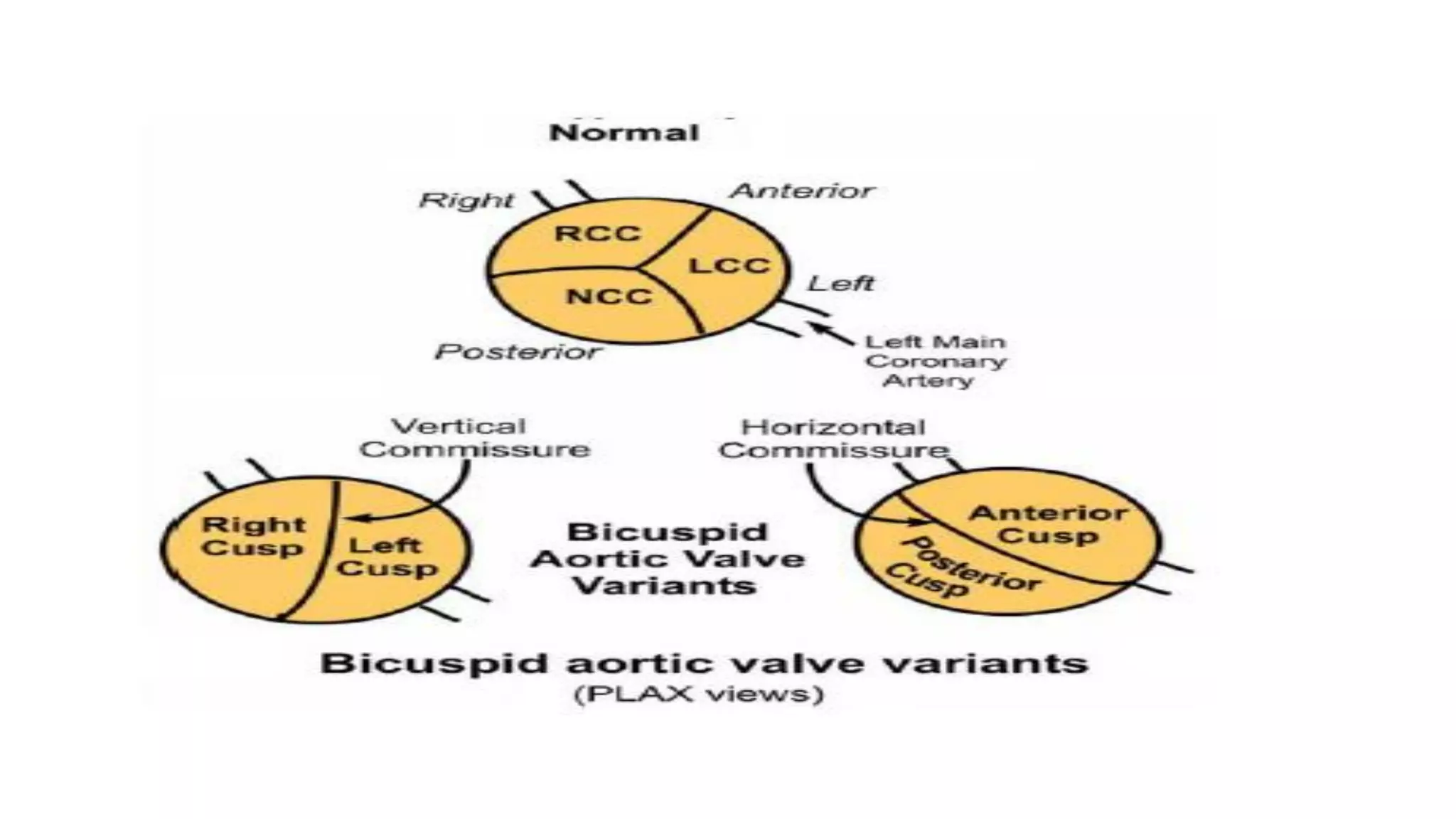 Echocardiographic evaluation of aortic valve and Aortic stenosis | PDF