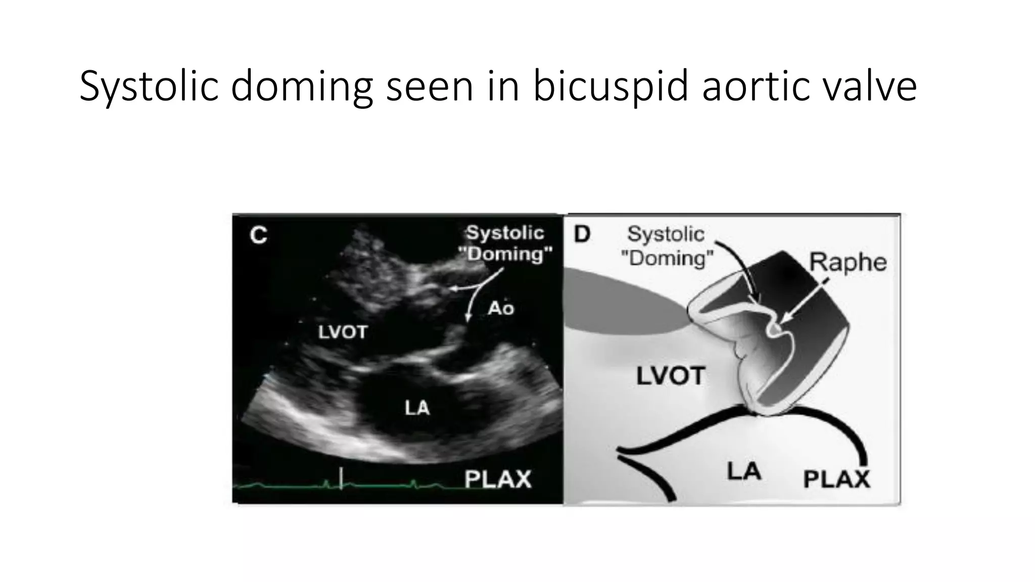 Echocardiographic evaluation of aortic valve and Aortic stenosis | PDF