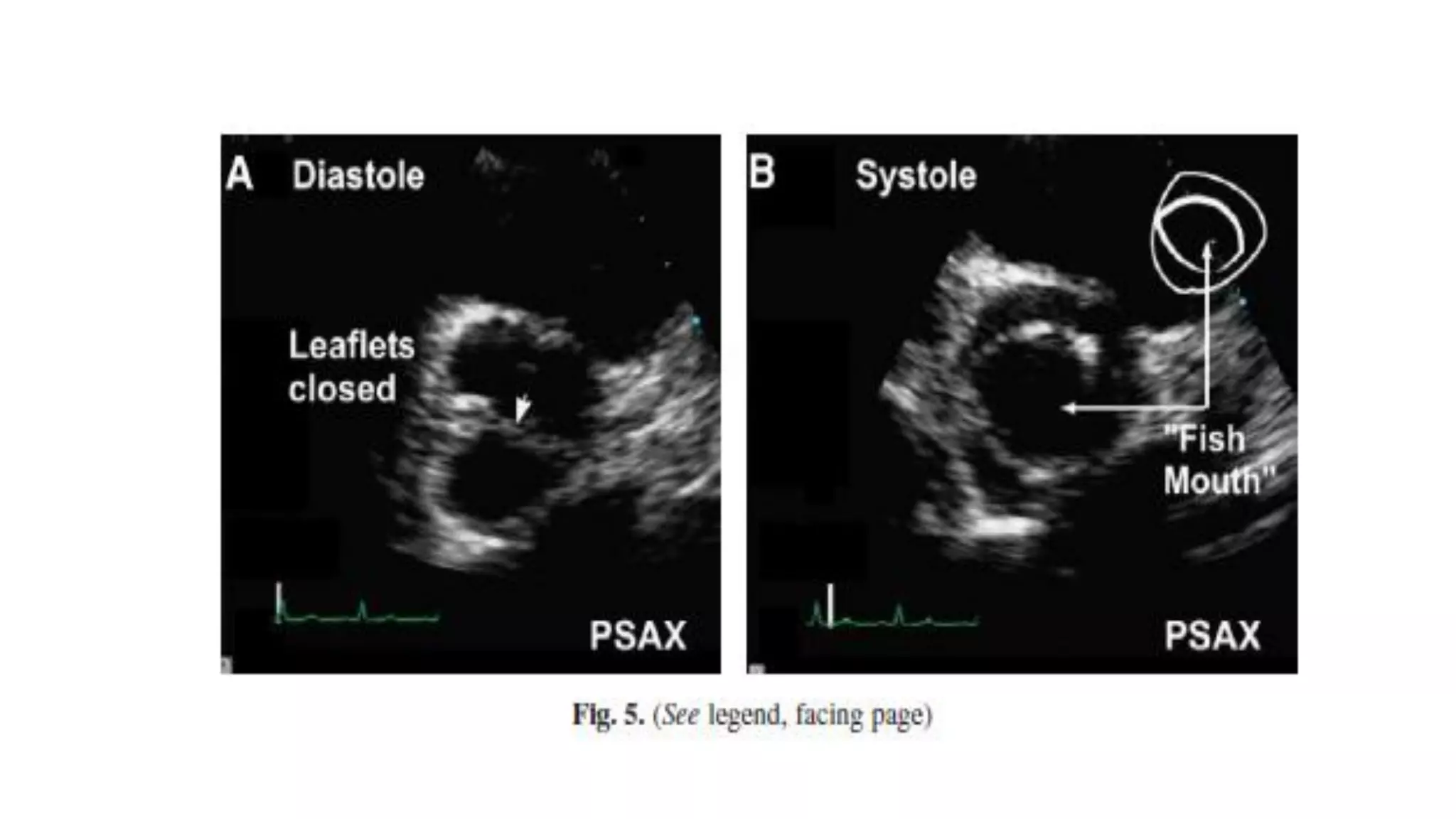 Echocardiographic evaluation of aortic valve and Aortic stenosis | PDF