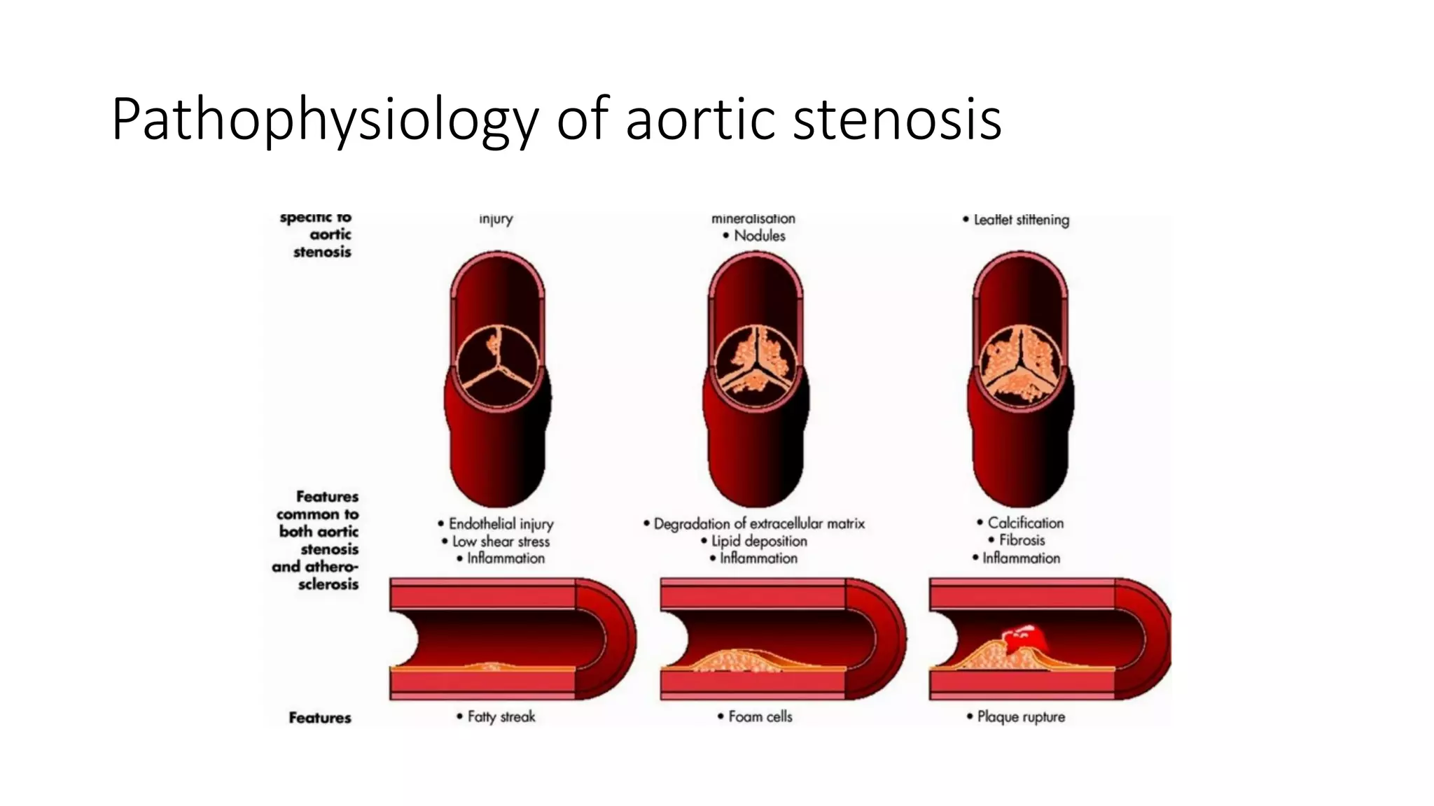 Echocardiographic evaluation of aortic valve and Aortic stenosis | PDF