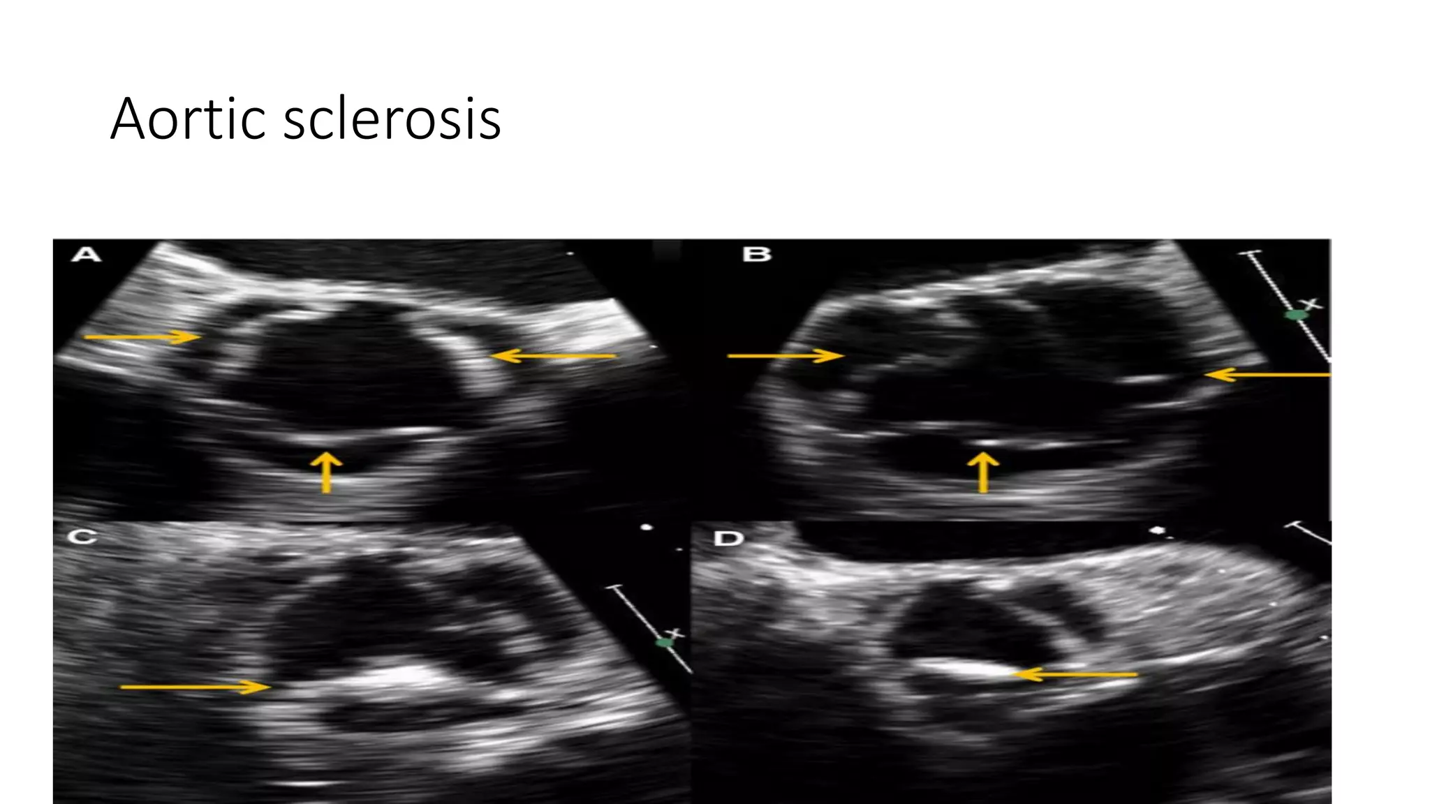 Echocardiographic evaluation of aortic valve and Aortic stenosis | PDF