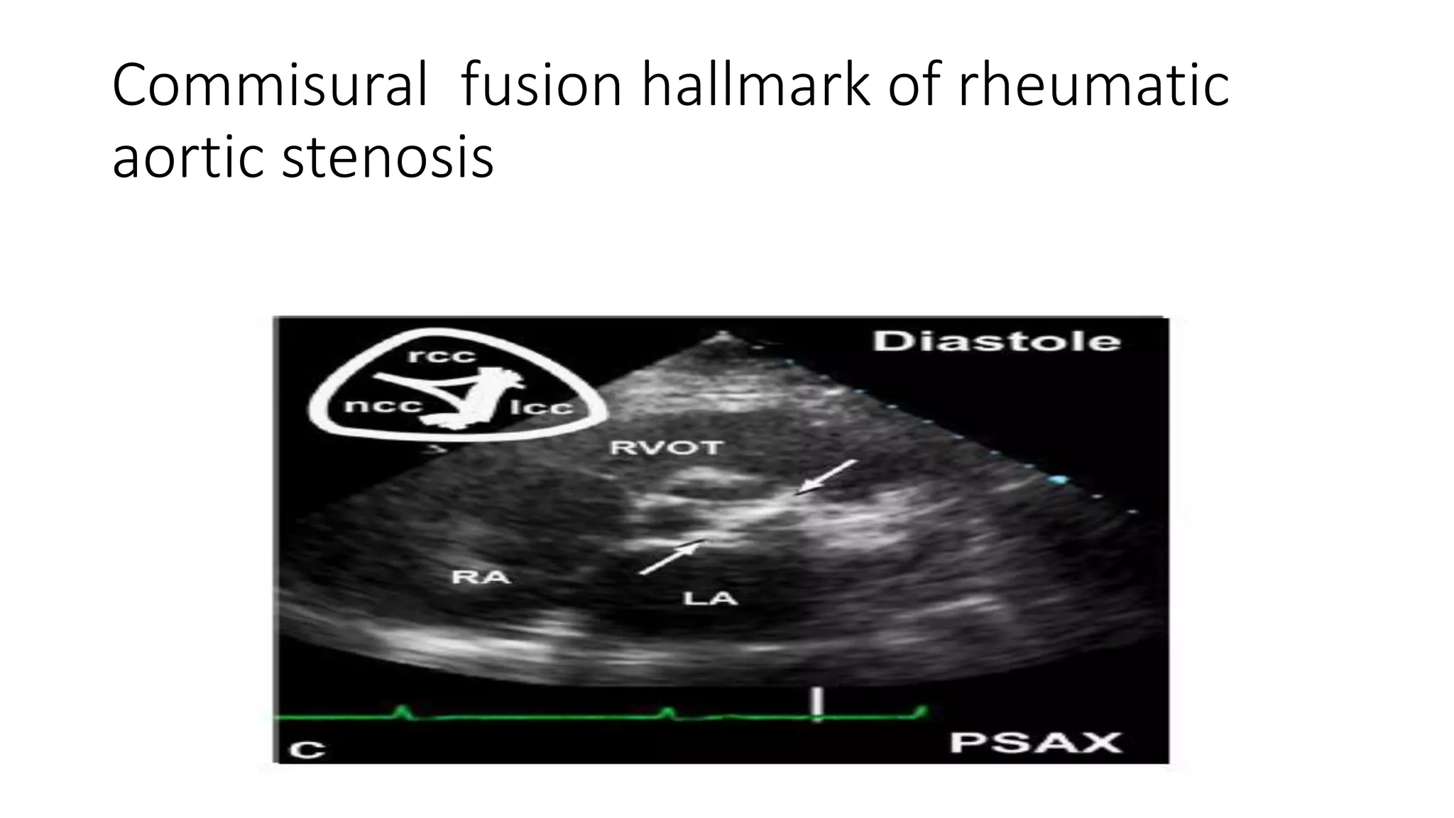 Echocardiographic evaluation of aortic valve and Aortic stenosis | PDF