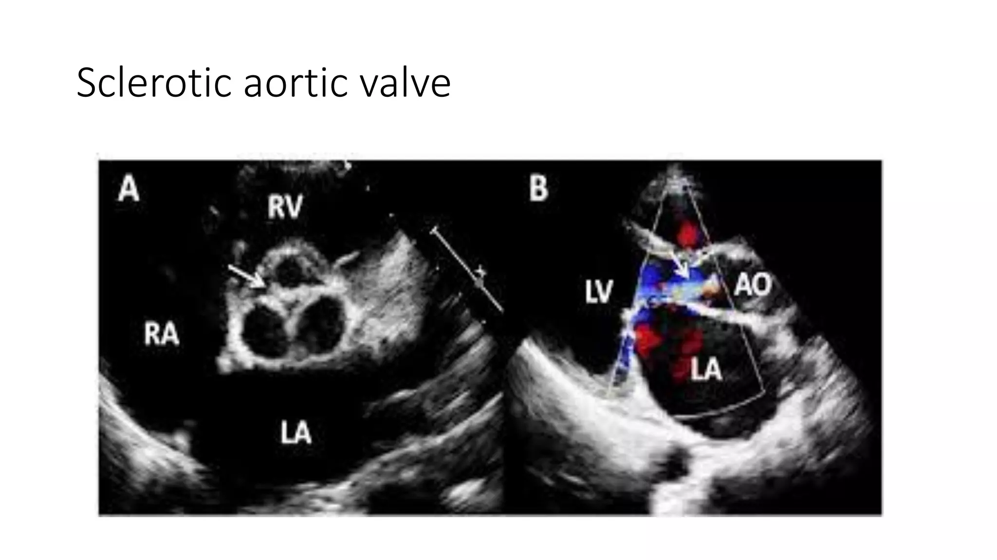 Echocardiographic evaluation of aortic valve and Aortic stenosis | PDF