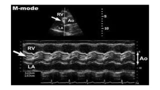 Bicuspid Aortic Valve M Mode
