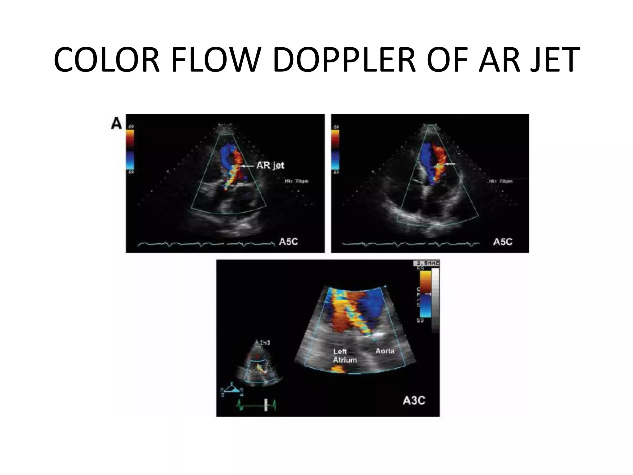 Echocardiographic evaluation of aortic regurgitation | PDF