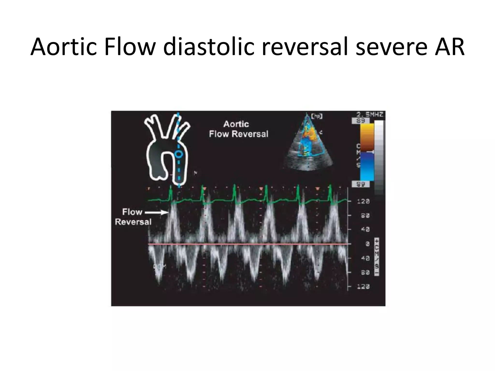 Echocardiographic evaluation of aortic regurgitation | PDF