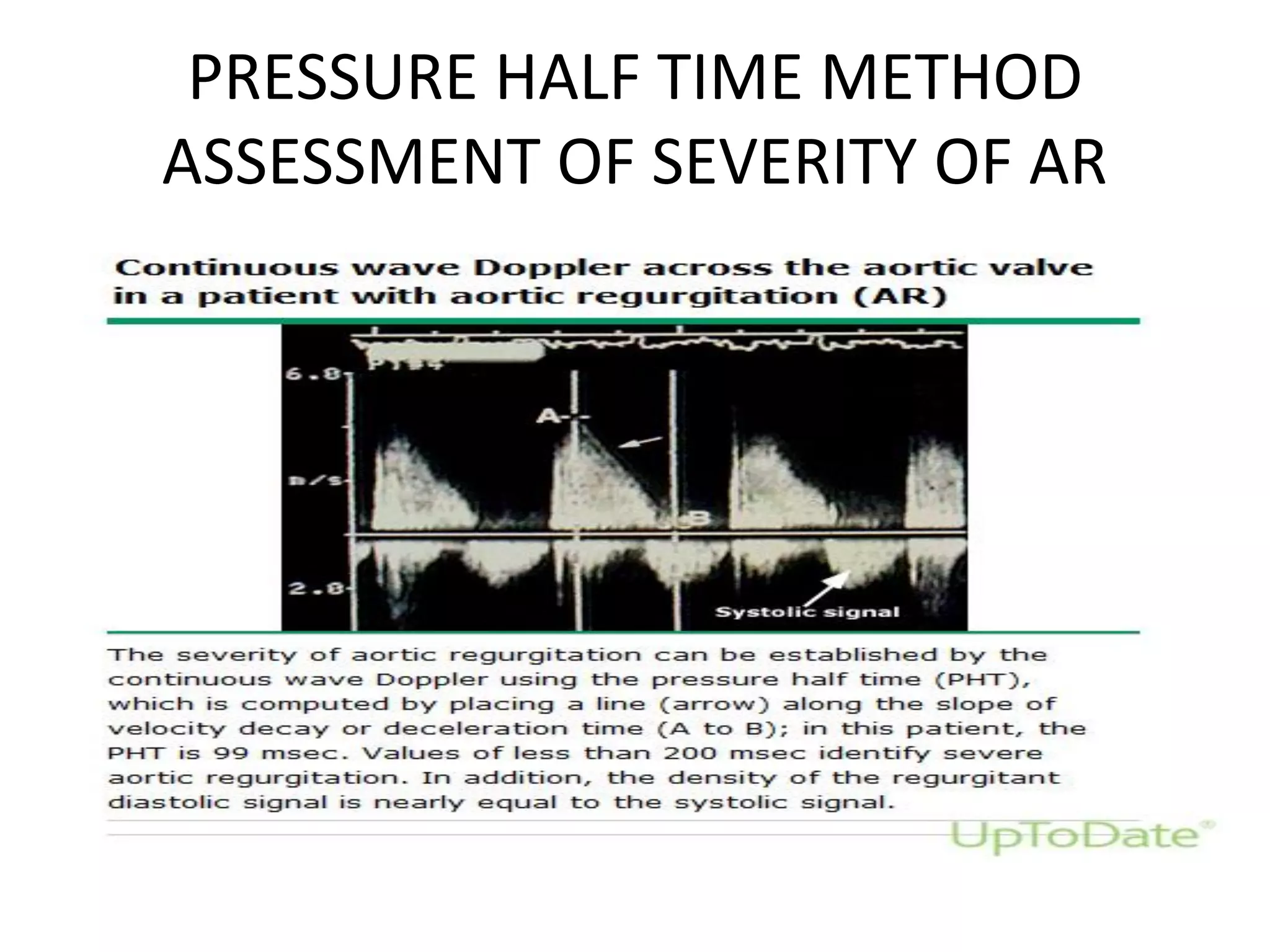 Echocardiographic evaluation of aortic regurgitation | PDF