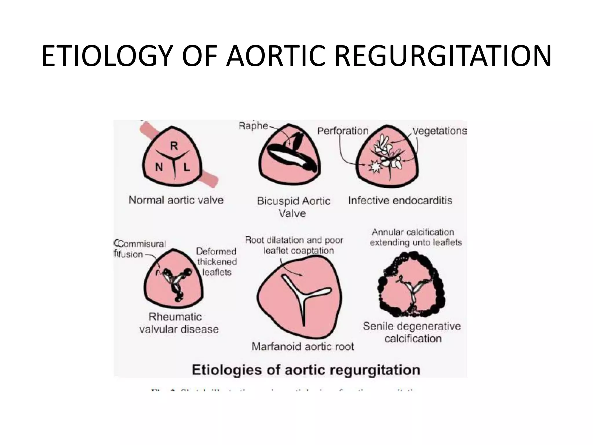Echocardiographic evaluation of aortic regurgitation | PDF
